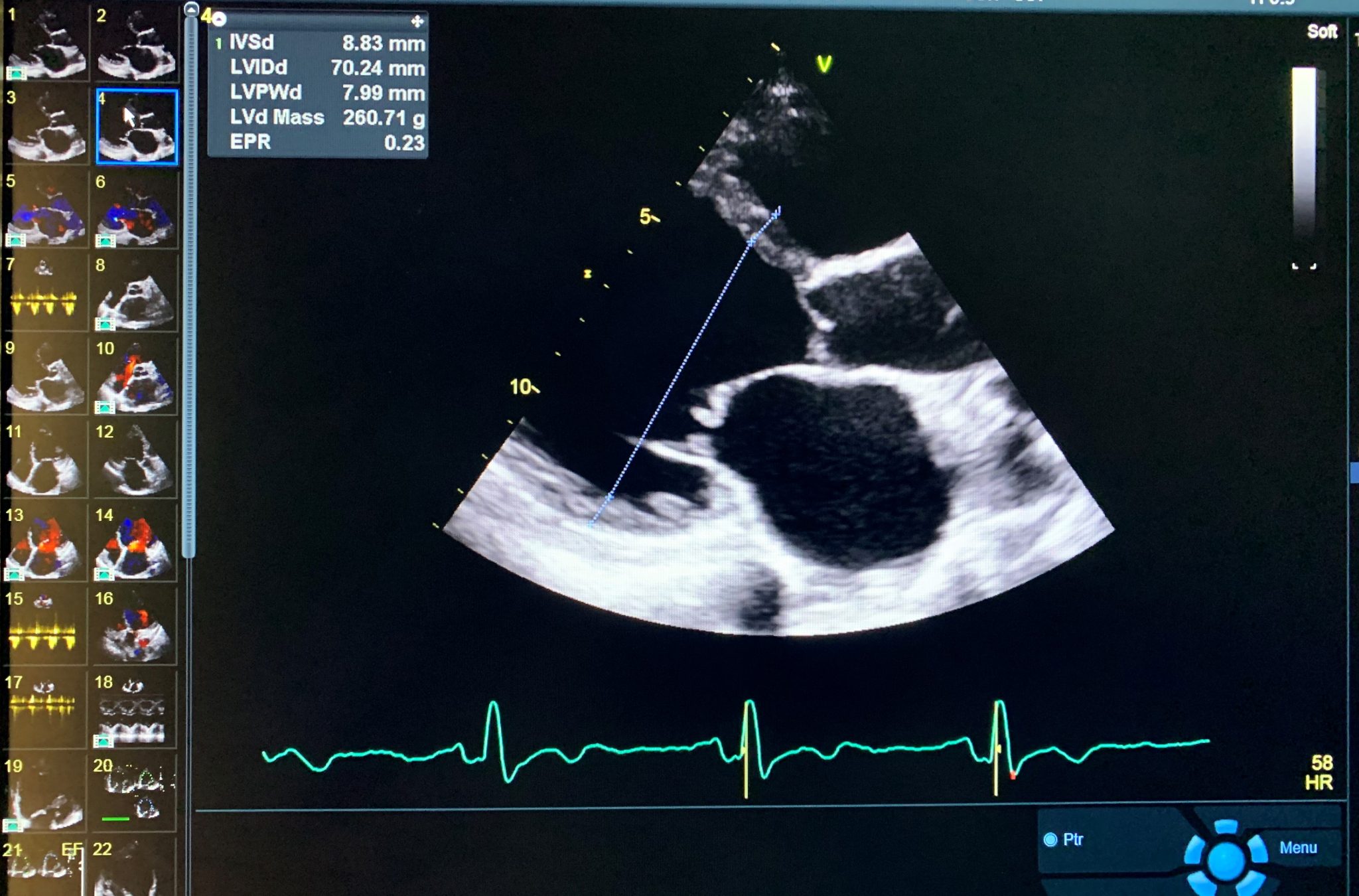 Ecocardiograma - ICV